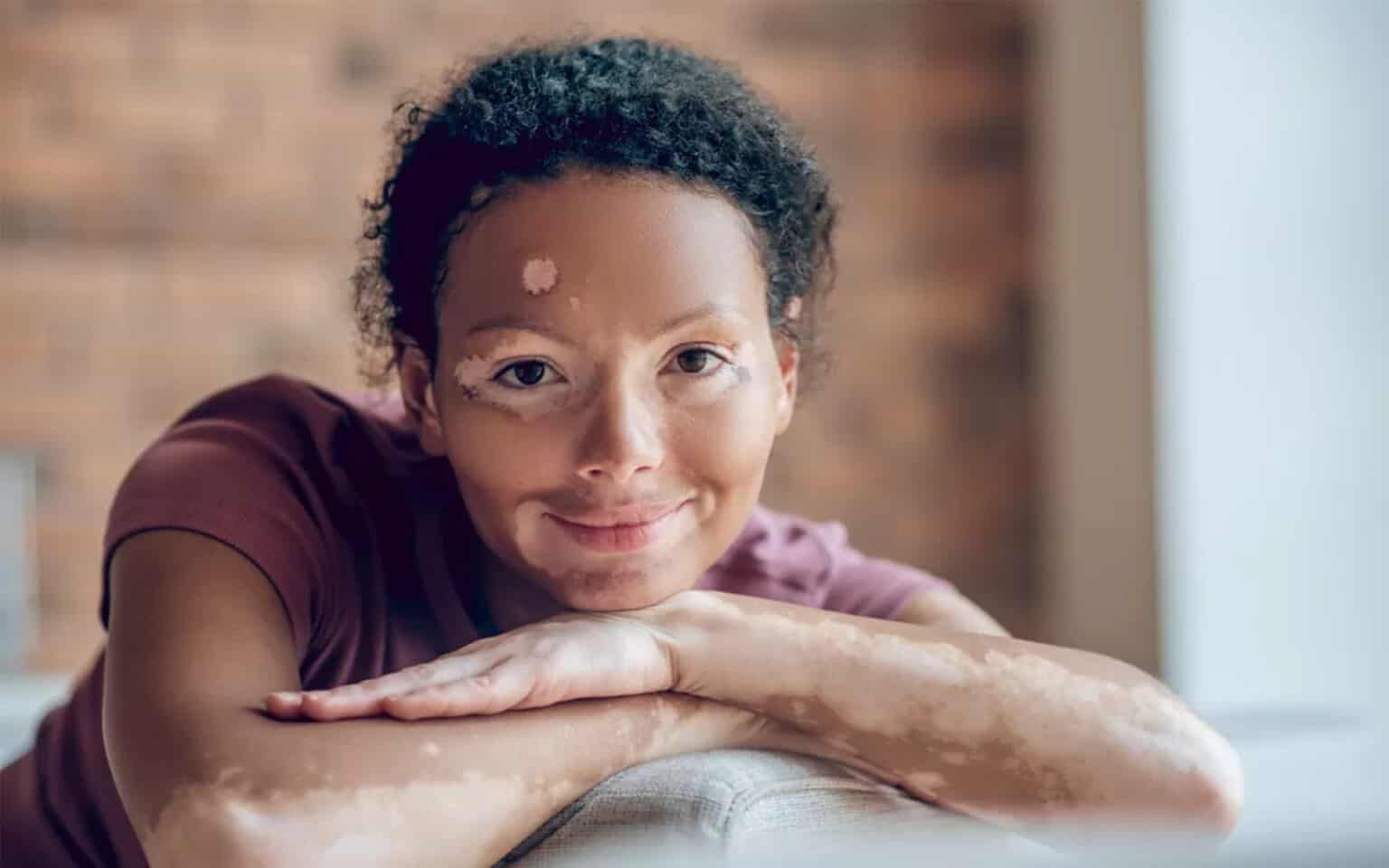 Бели петна по кожата: възможни причини и лечение - AromaMag